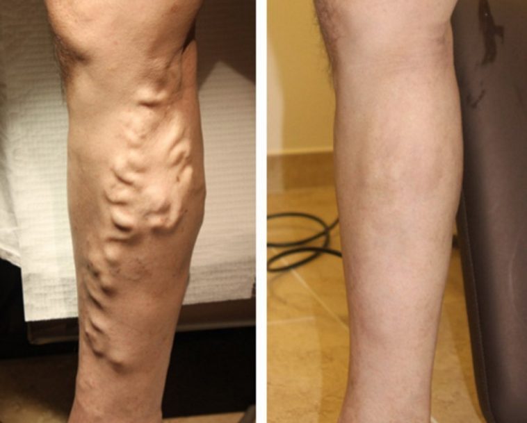 Isso Elimina Todas As Varizes Das Pernas Para Sempre Como Usar E Receitas Dicas De Beleza